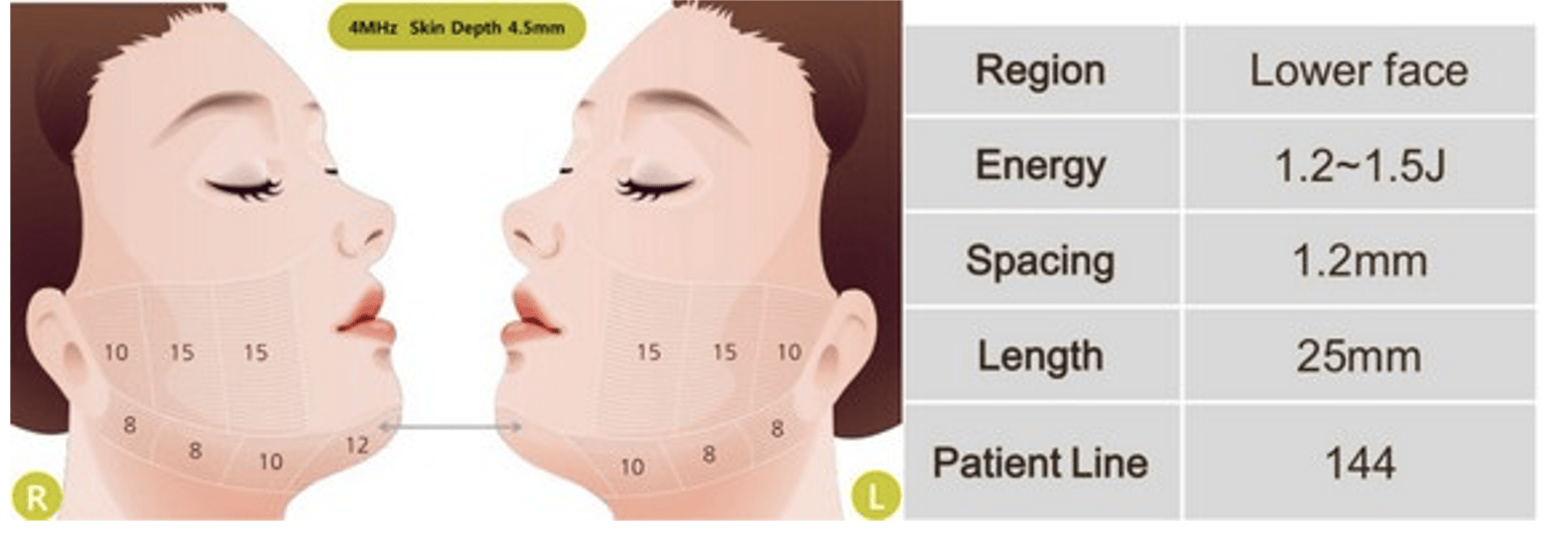 HIFU Facial - Step by Step Guide - Hampson Training